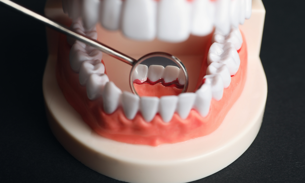 Understanding Gum Grafting in Gig Harbor, WA: An In-Depth Guide