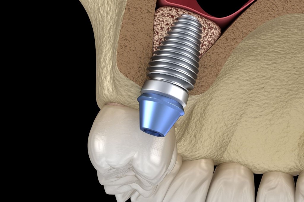 Sound Surgical Arts | Sinus Grafting for Implants Gig Harbor
